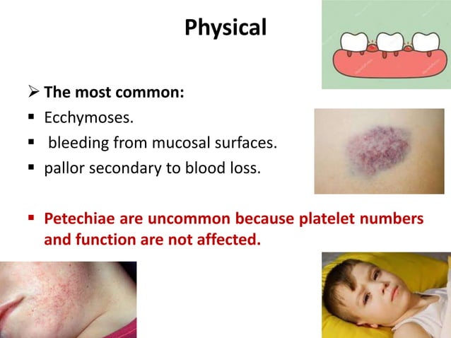 Factor v deficiency | PPT