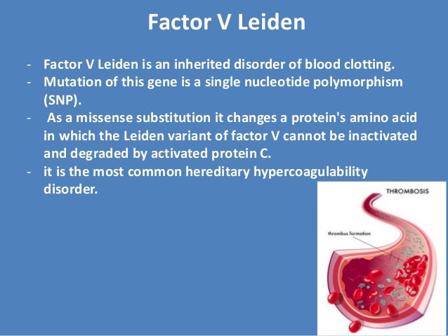 Factor V Leiden In Abortion factor-v-leiden-in-abortion