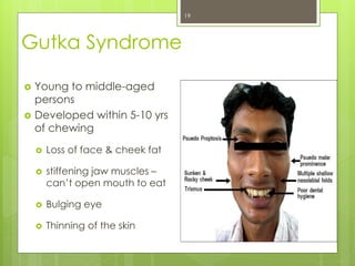 Facts about the Dangers of Betel Nut Chewing | PDF