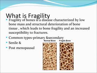 Facts and figures about osteoporosis in rural india11 | PPT
