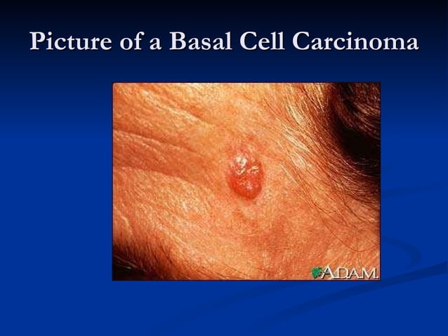 Facts Of Skin Cancer | PPT | Skin and Dermatology | Diseases and Conditions