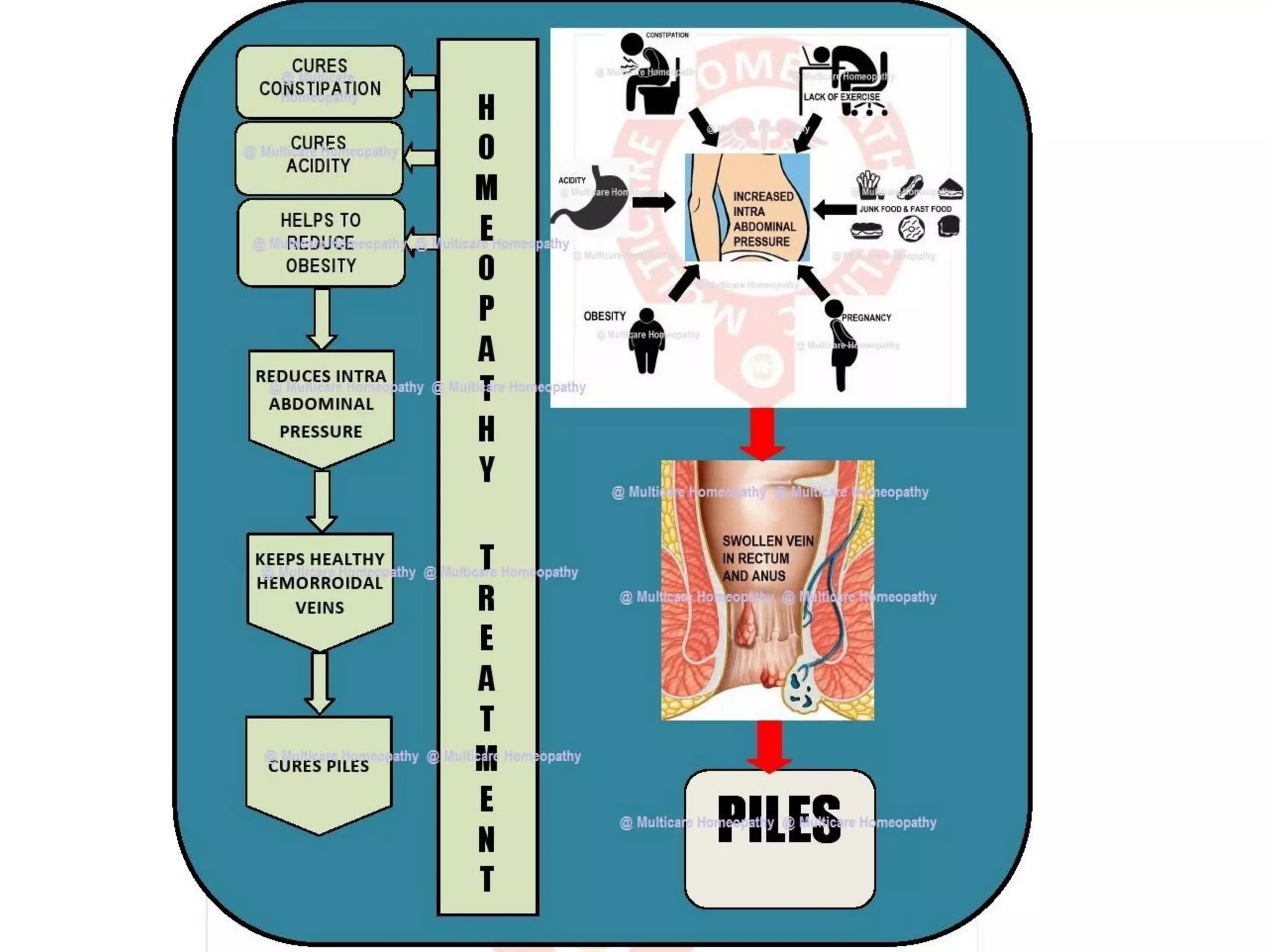 Facts to know about piles and the scope of homeopathy treatment in ...