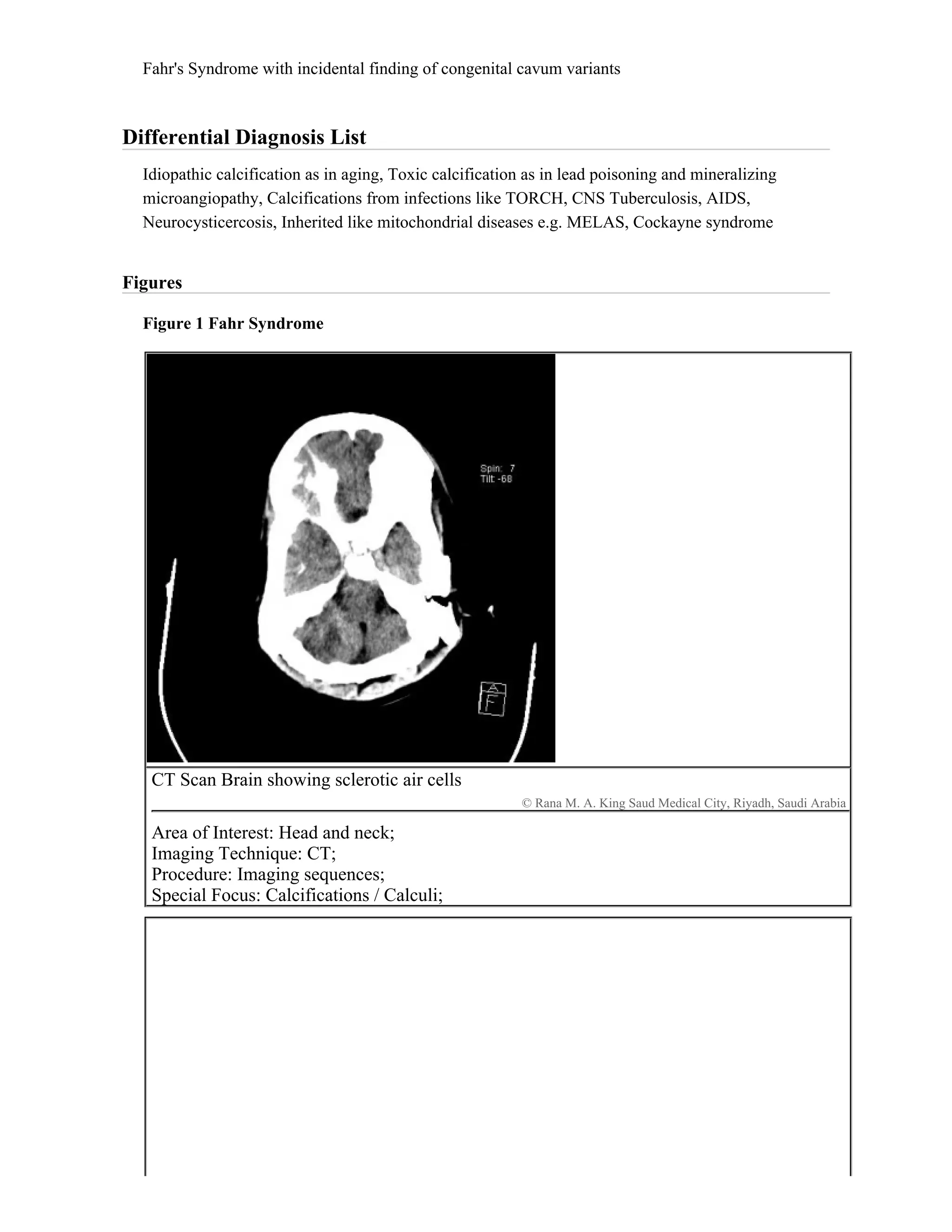 Fahr disease with congenital cavum variants | PDF