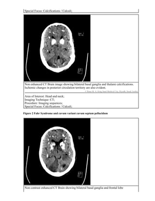 Fahr disease with congenital cavum variants | PDF