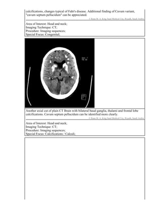 Fahr disease with congenital cavum variants | PDF