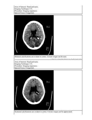 Fahr disease with congenital cavum variants | PDF