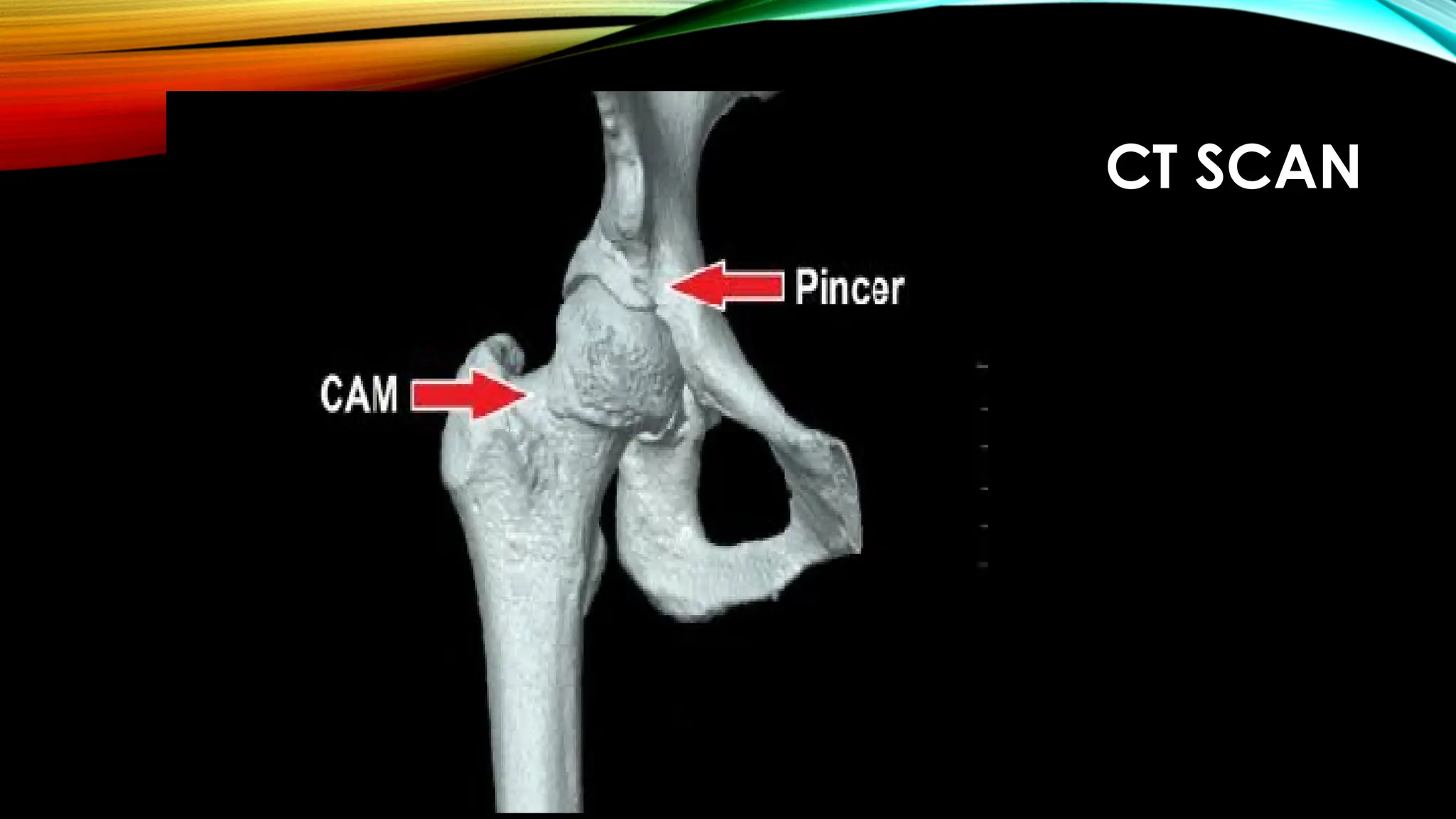 Femoroacetabular impingement types .pptx