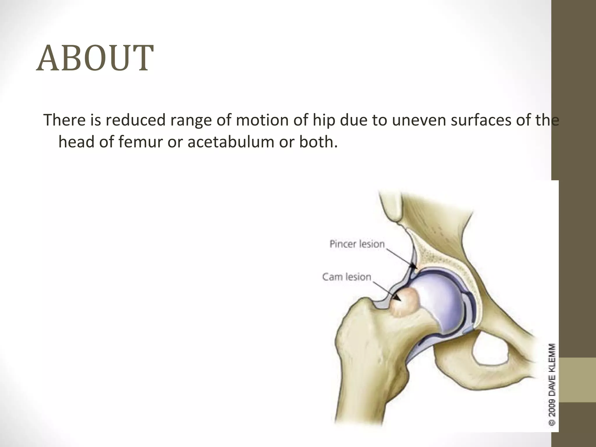 Femoro-acetabular impingement syndrome | PPT