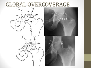 Femoro-acetabular impingement syndrome | PPT | Death, Injury, or ...