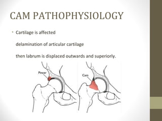 Femoro-acetabular impingement syndrome | PPT