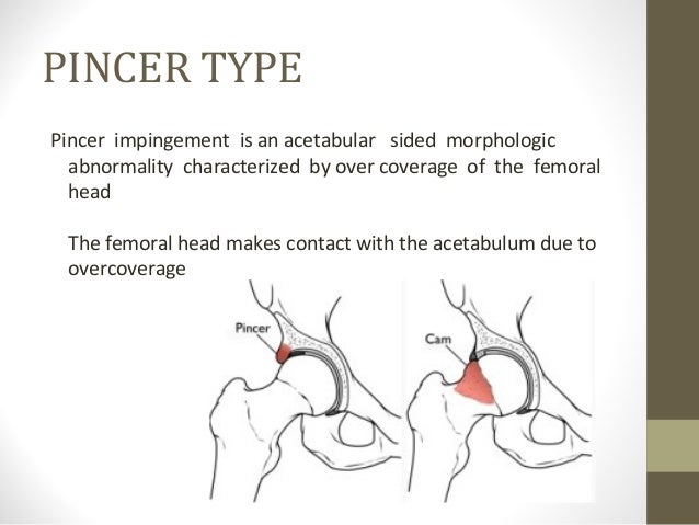 Femoro-acetabular impingement syndrome