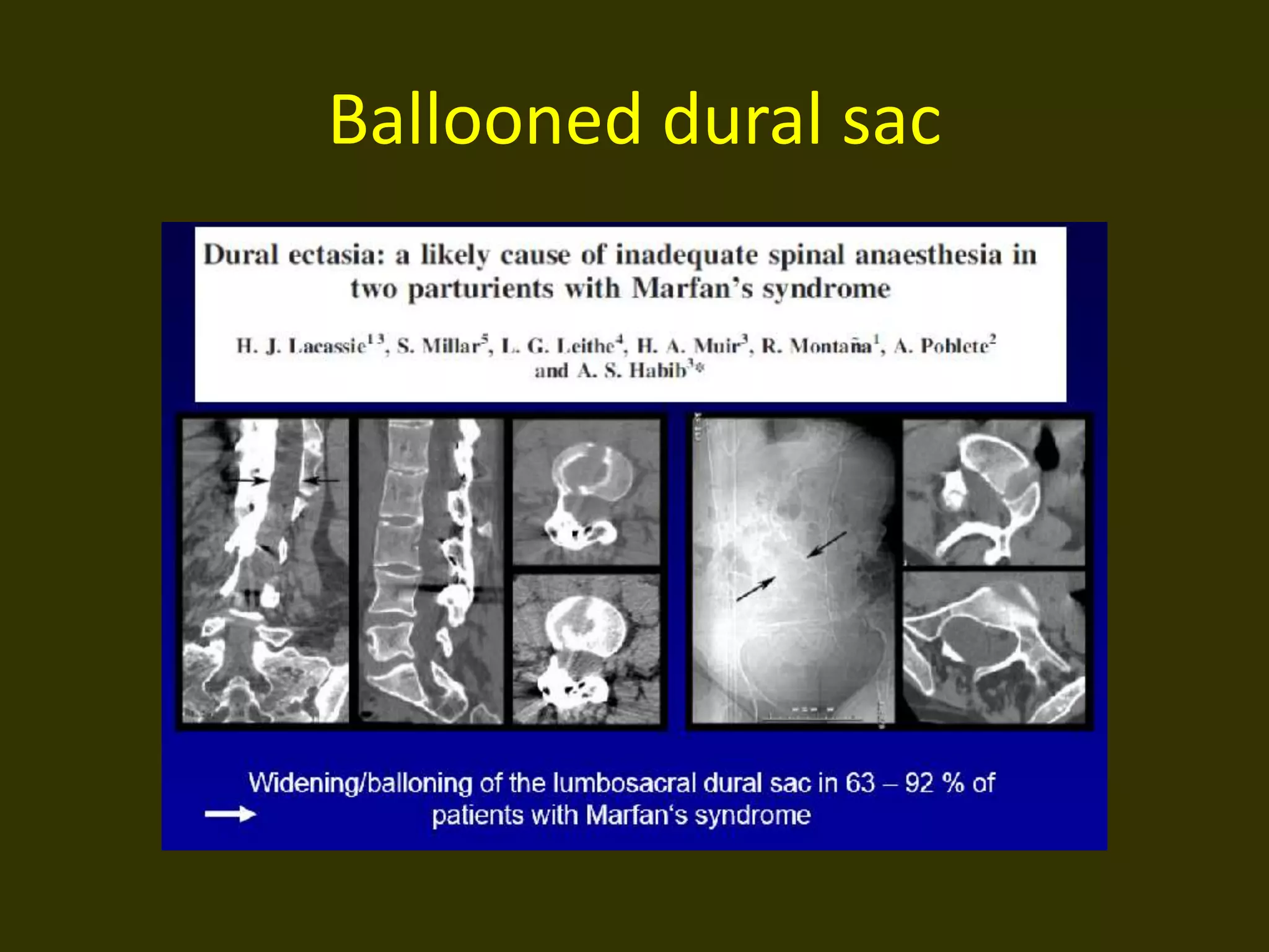 Failed spinal-anesthesia-mgmc | PPTX