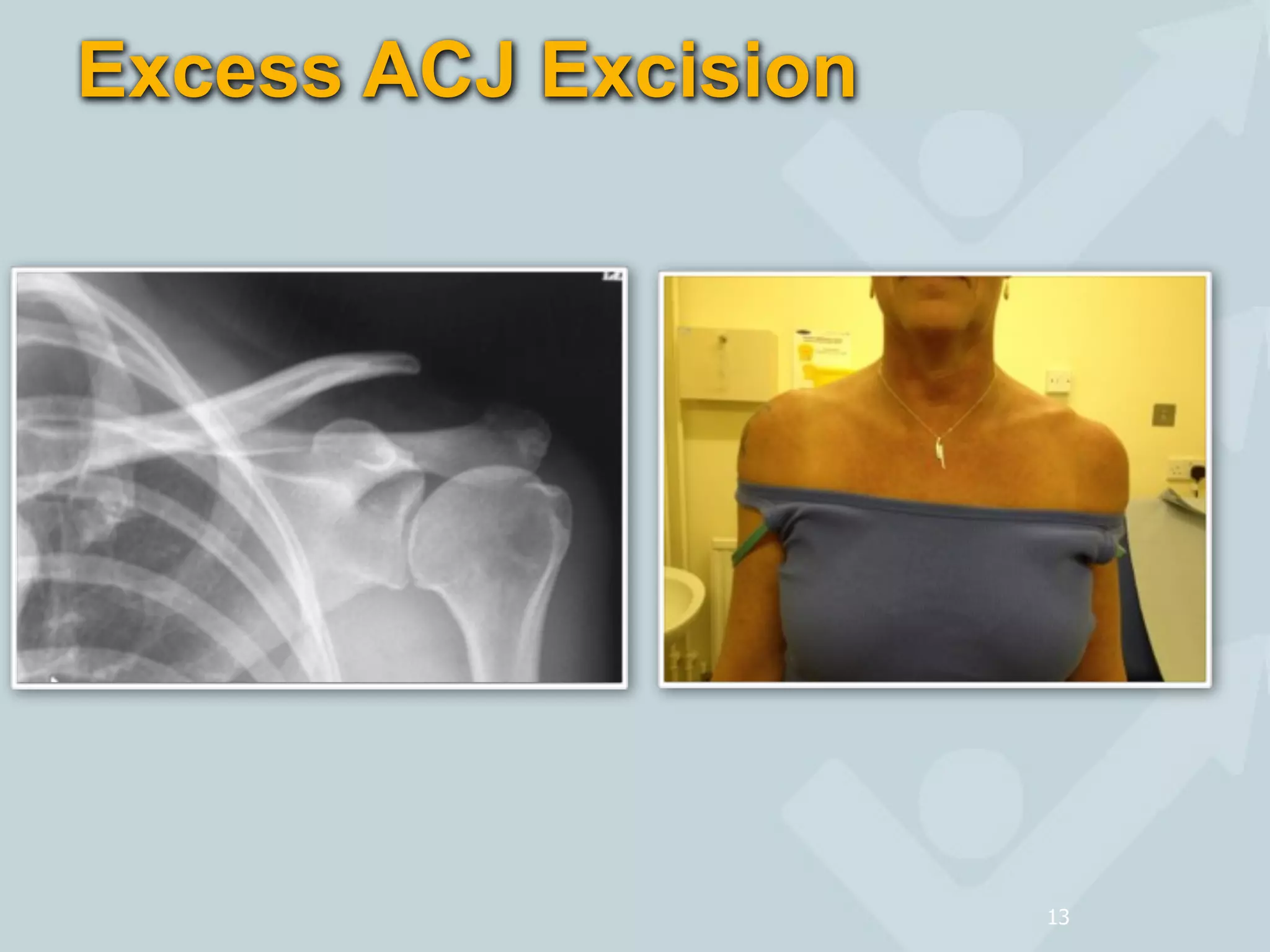 Failed acj excision | KEY