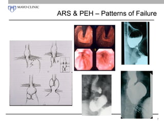 Failed Fundoplication Surgery | PPT