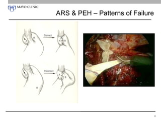 Failed Fundoplication Surgery | PPT