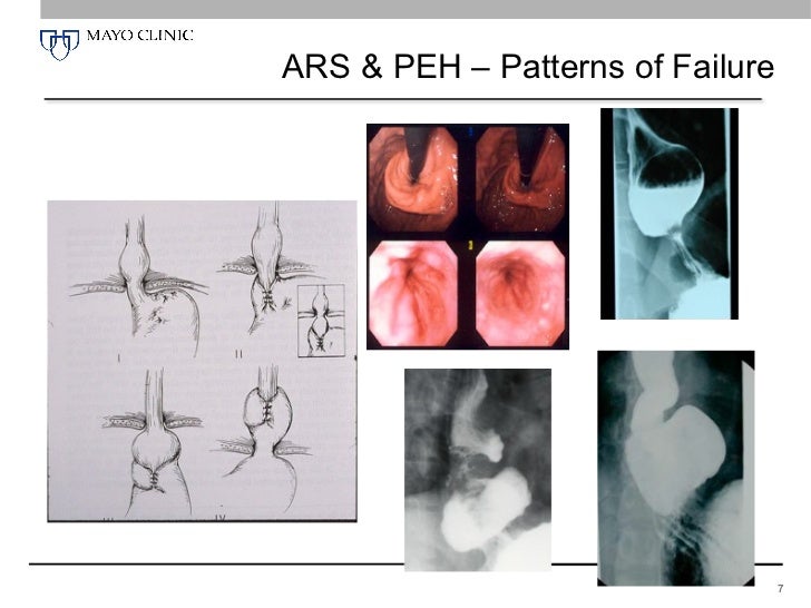 Failed Fundoplication Surgery