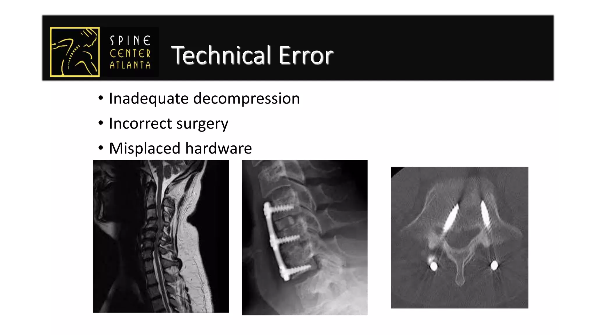 Failed back surgery syndrome - A comprehensive overview | PPTX