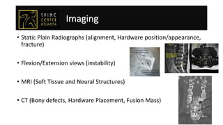 Failed back surgery syndrome - A comprehensive overview | PPTX