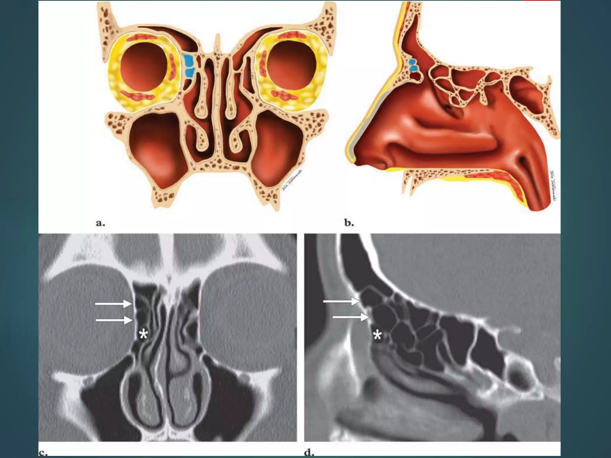 Failed fess spectrum of ct findings in the frontal recess | PPT