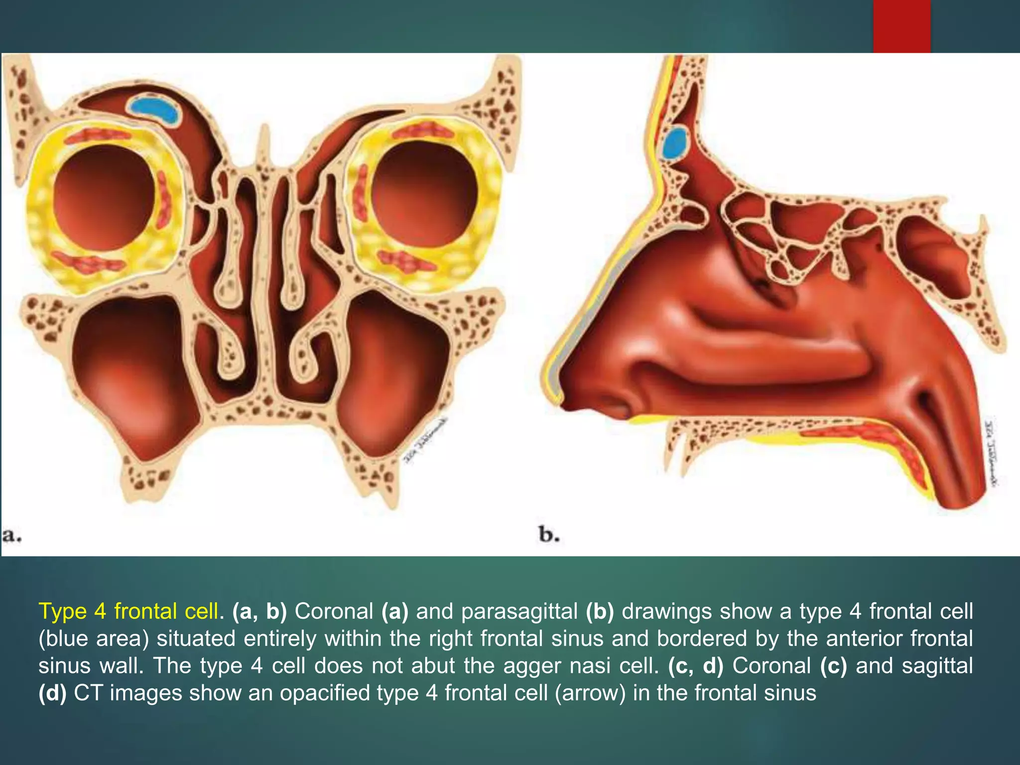 Failed fess spectrum of ct findings in the frontal recess | PPT