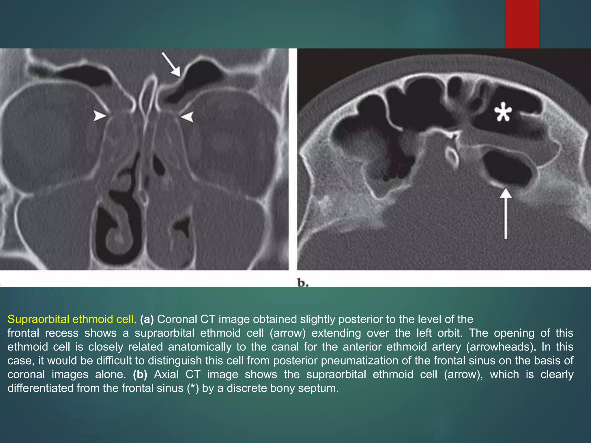 Failed fess spectrum of ct findings in the frontal recess | PPT