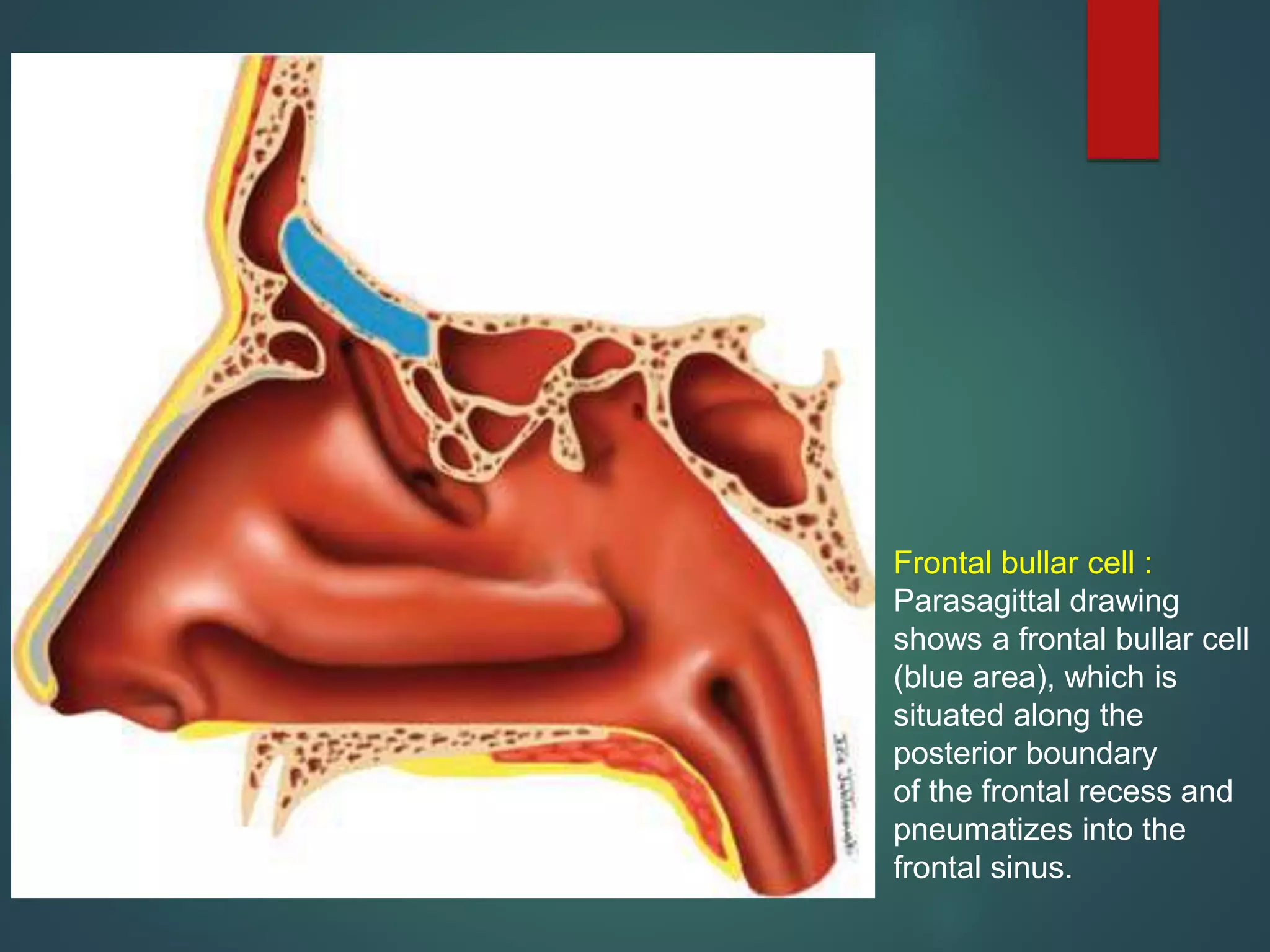 Failed fess spectrum of ct findings in the frontal recess | PPT