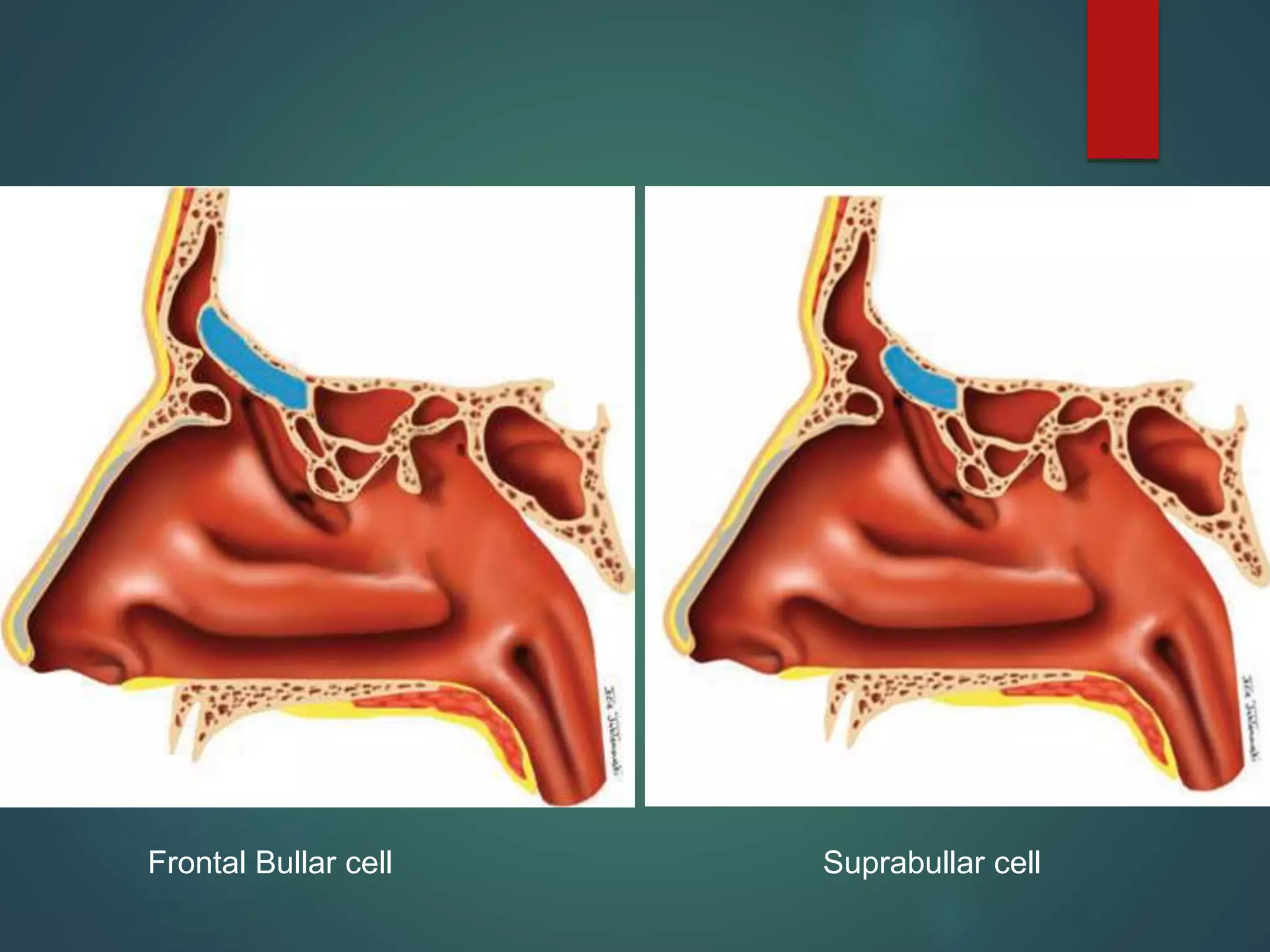 Failed fess spectrum of ct findings in the frontal recess | PPT