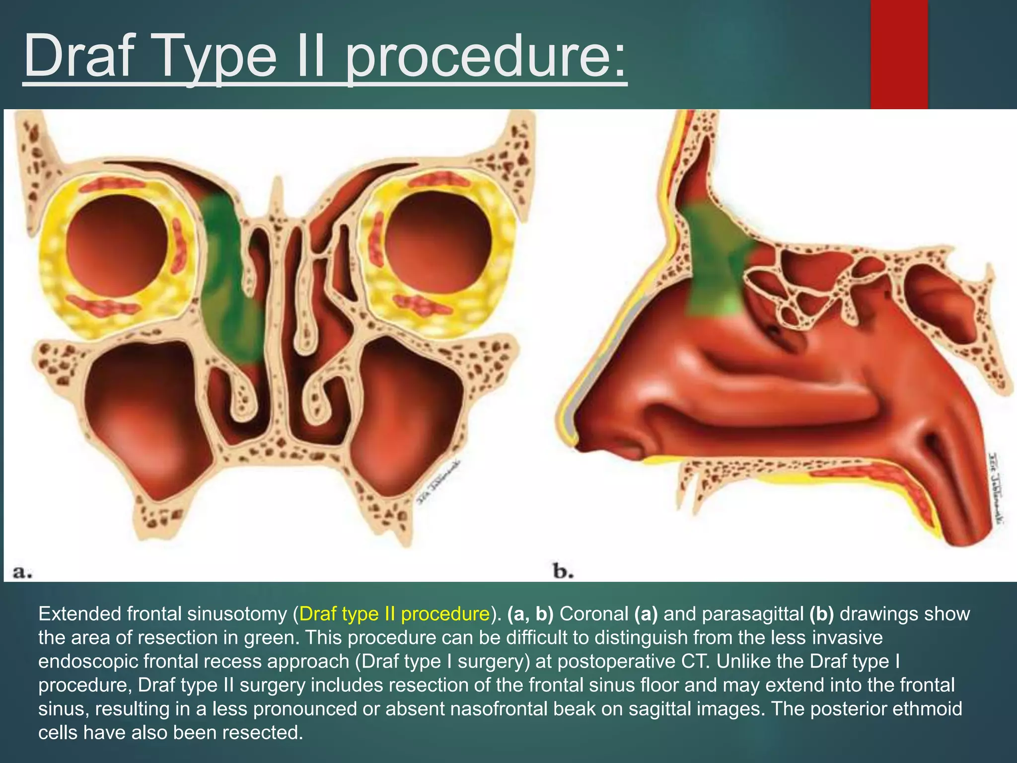 Failed fess spectrum of ct findings in the frontal recess | PPT