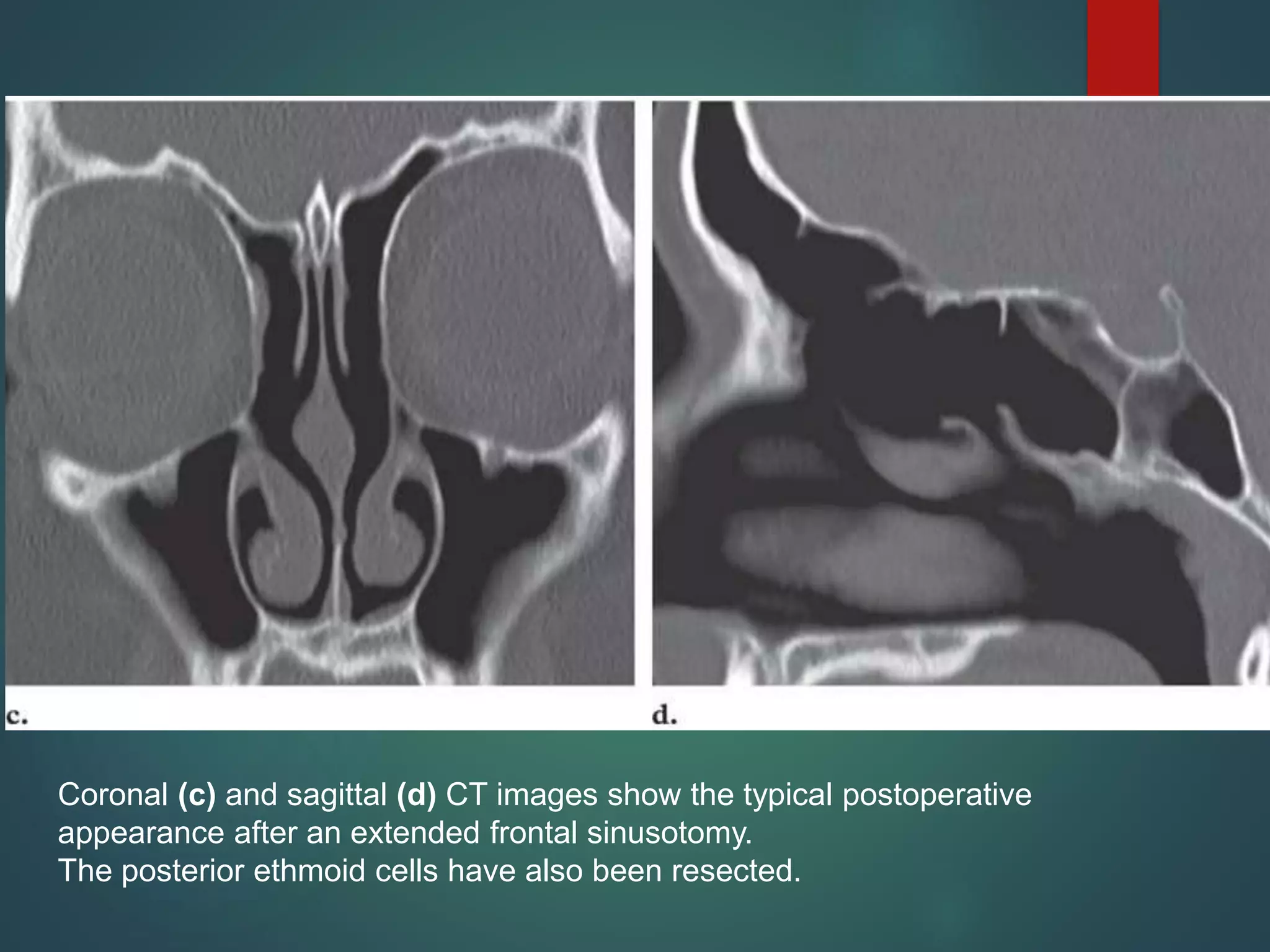 Failed fess spectrum of ct findings in the frontal recess | PPT