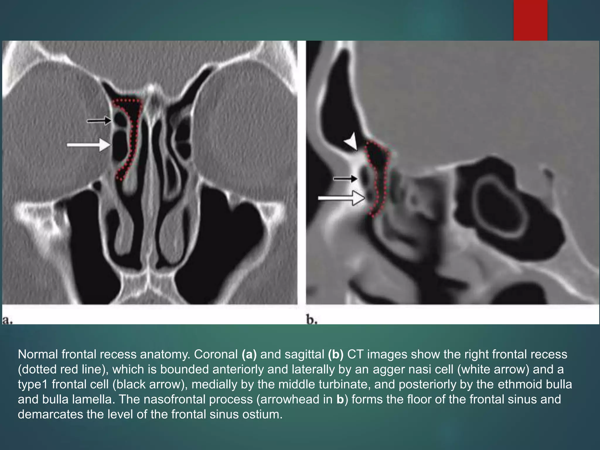 Failed fess spectrum of ct findings in the frontal recess | PPT