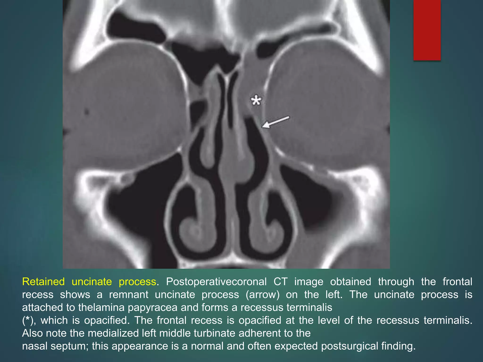 Failed fess spectrum of ct findings in the frontal recess | PPT