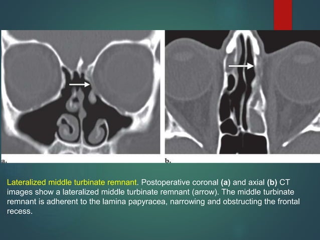Failed fess spectrum of ct findings in the frontal recess | PPT