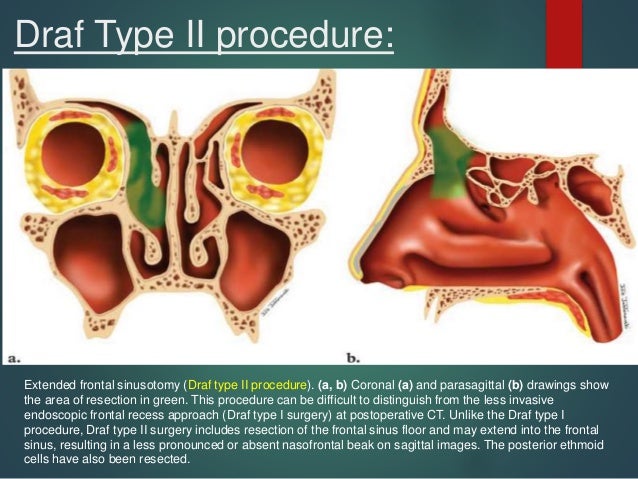 Failed fess spectrum of ct findings in the frontal recess