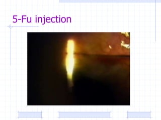 Failed filtration surgery | PPT