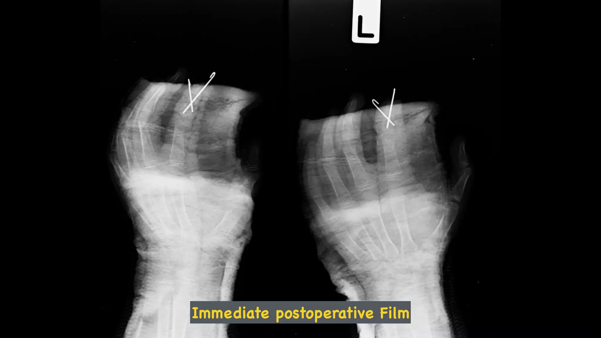 Failed phalangeal and metacarpal fracture management | PDF
