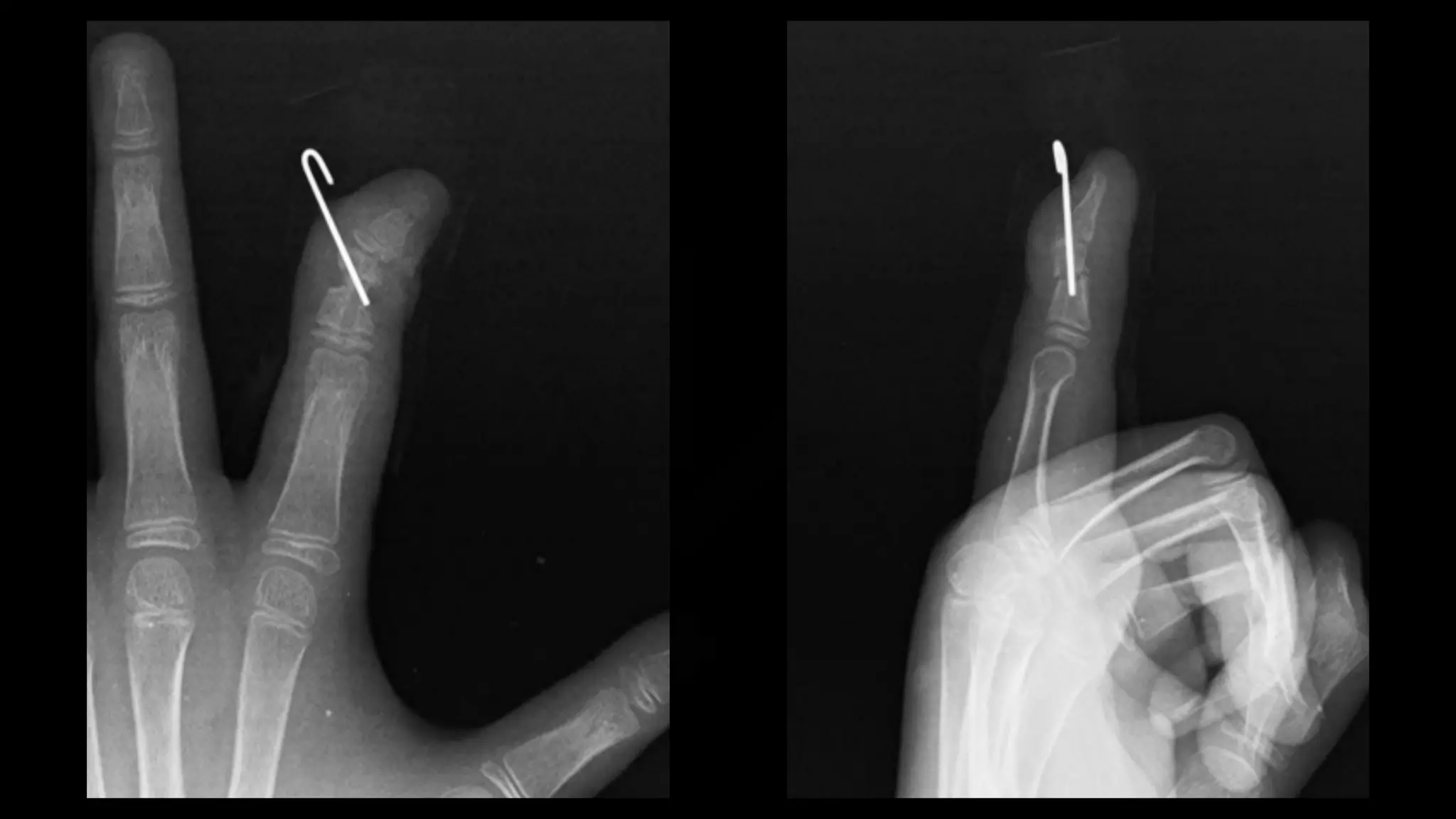 Failed phalangeal and metacarpal fracture management | PDF