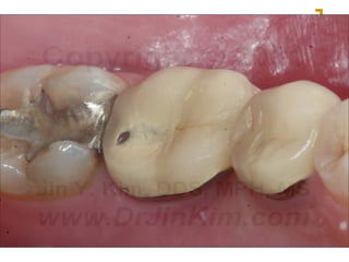 Failed root resection case | PPT