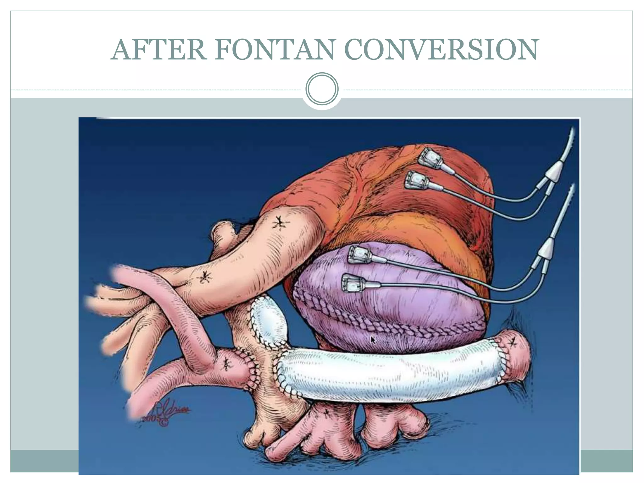 Failing Fontans - by Nihar Mehta | PPT