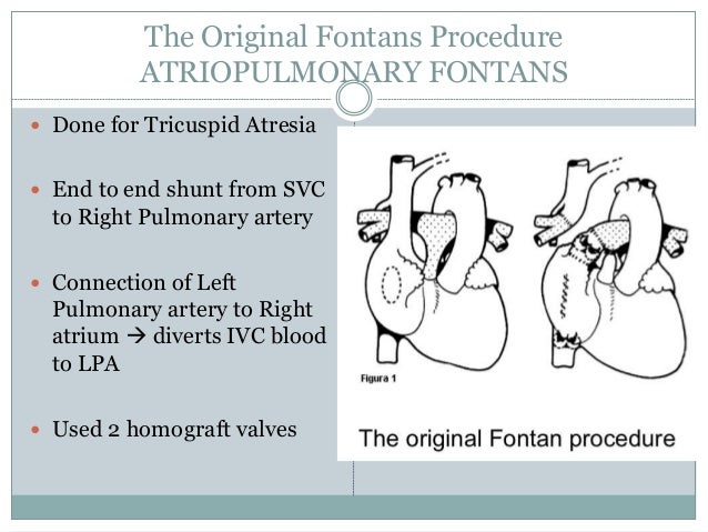 Failing Fontans - by Nihar Mehta
