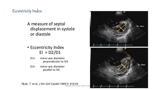 Failing Right Ventricle in PAH , How to manage?