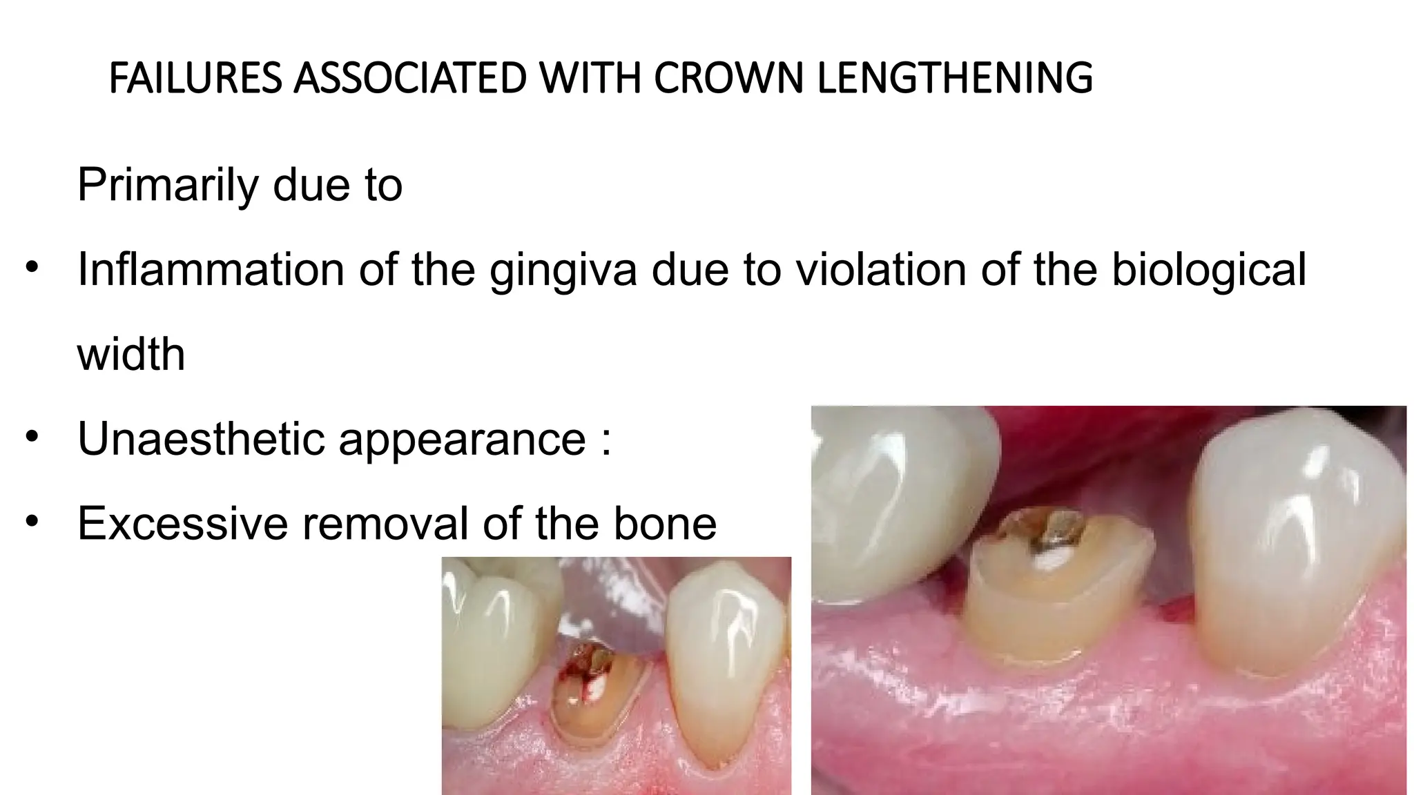 failure in Periodontal Therapy - Dr Smijal Gopalan Marath - Specialist ...