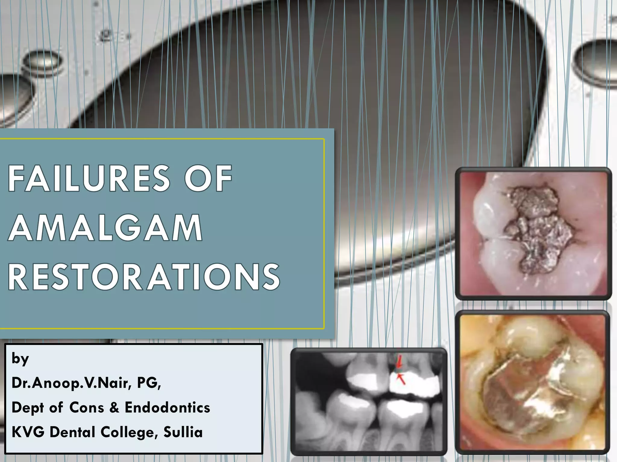 Failure of amalgam | PDF