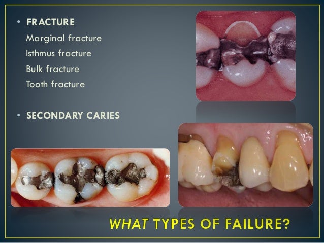 Failure of amalgam