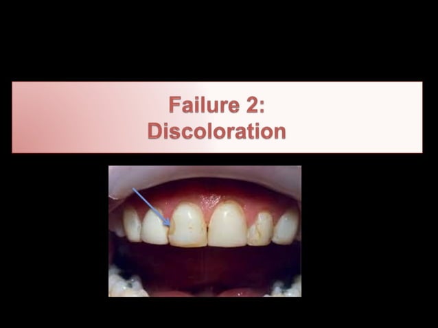 failure of composite restoration by Dr Islam Alsakkaf.pptx