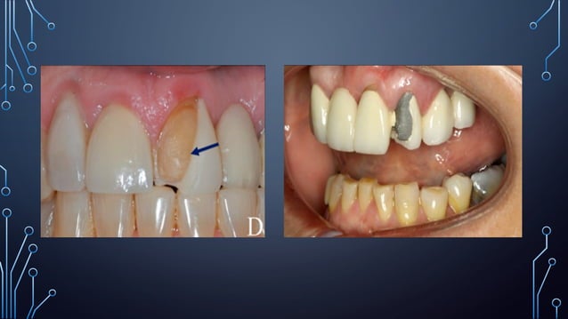 Failure of Crowns and Fixed Dental Prosthesis BY Mashiat and Sabha.pptx