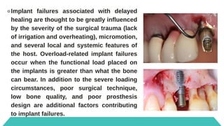 Failure of dental implant...........pptx