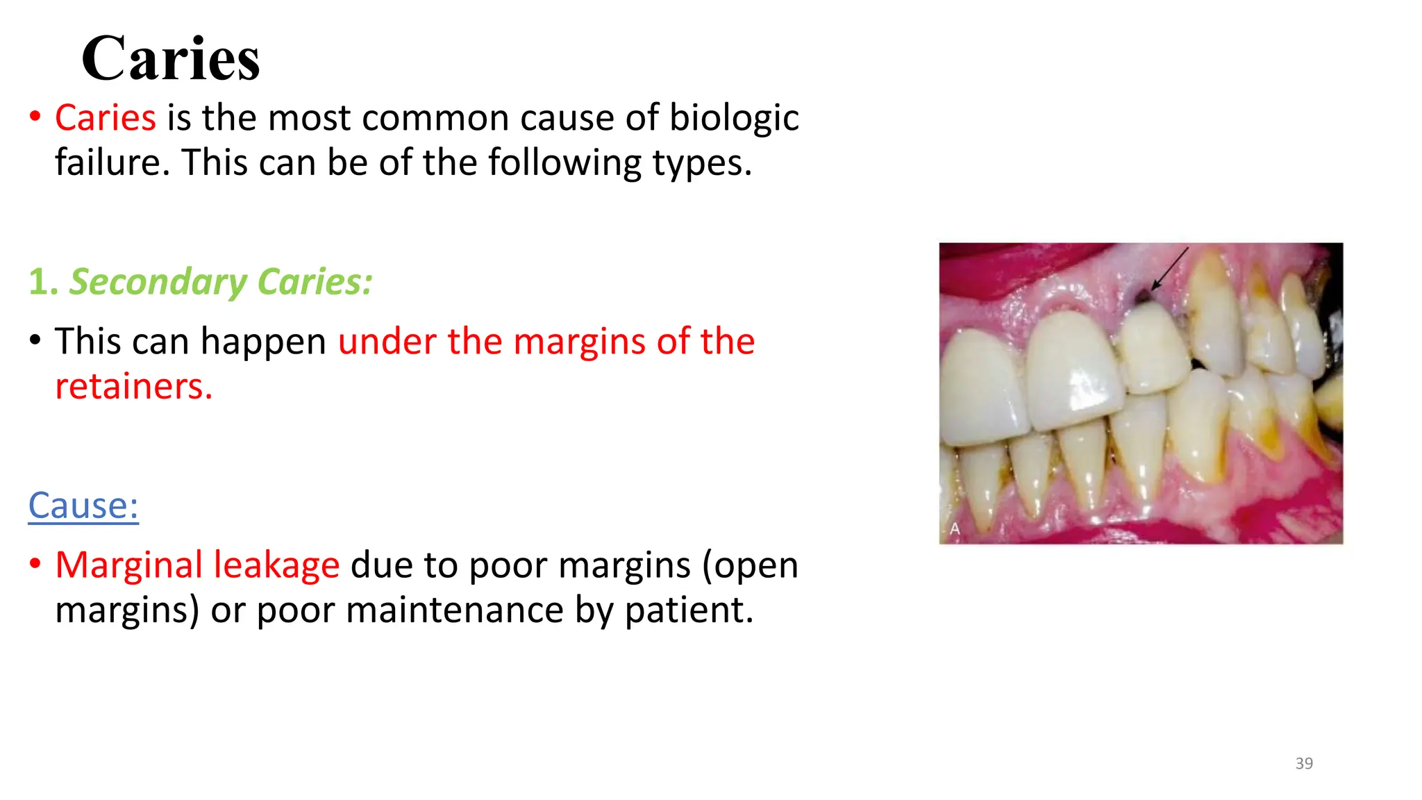different failures in fixed partial denture | PPTX
