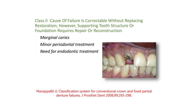 different failures in fixed partial denture | PPTX | Dental Health ...