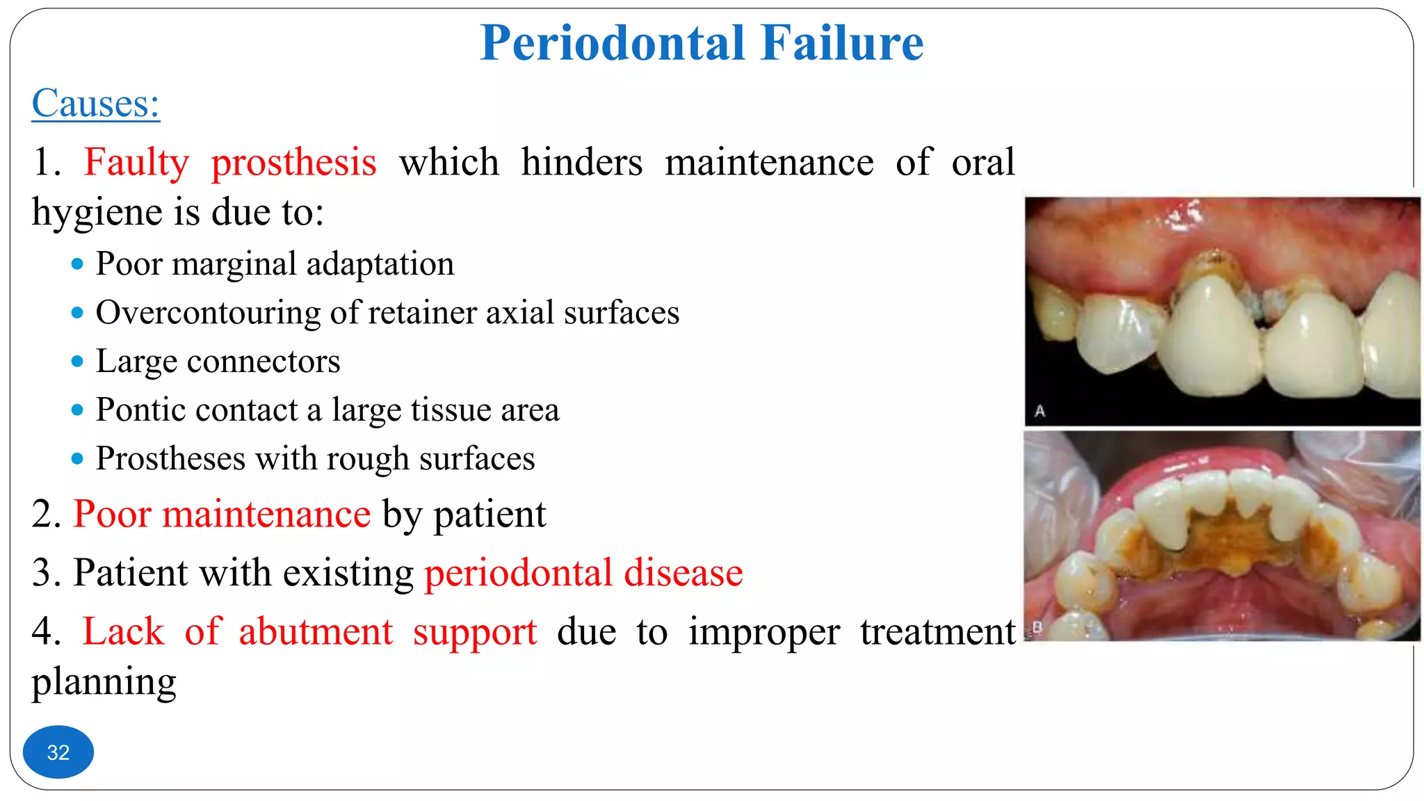 Failures in Fixed Partial Denture | PPTX