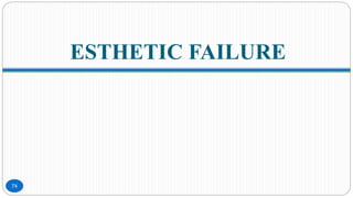 Failures in Fixed Partial Denture | PPTX